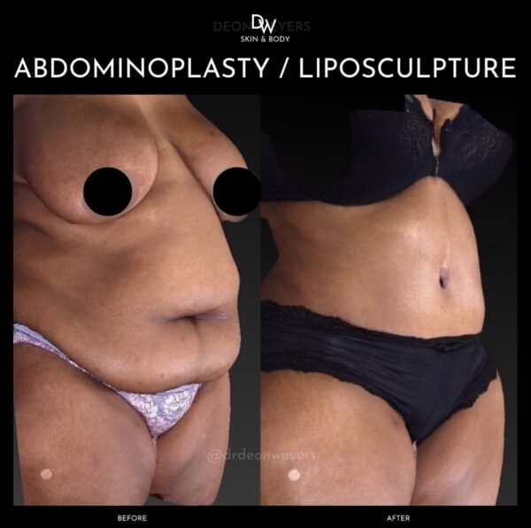 Tummy Tuck Before And After Photos South Africa Dr Deon Weyers 4756