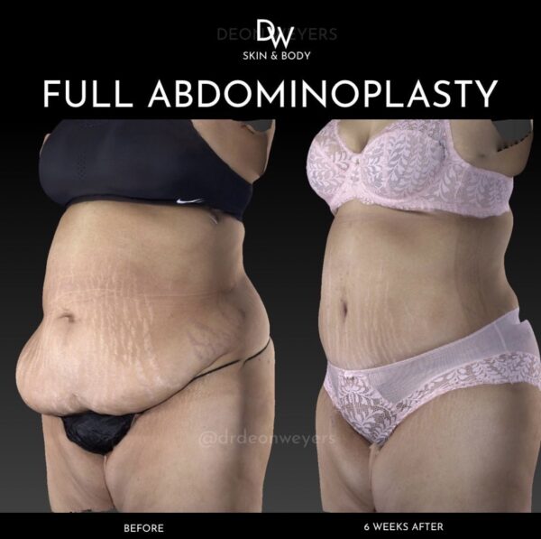 Tummy Tuck Before And After Photos South Africa Dr Deon Weyers 3166